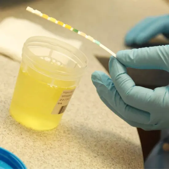 Urinary Calcium | Test Price In Delhi | Cost Near Me, India | Ganesh ...