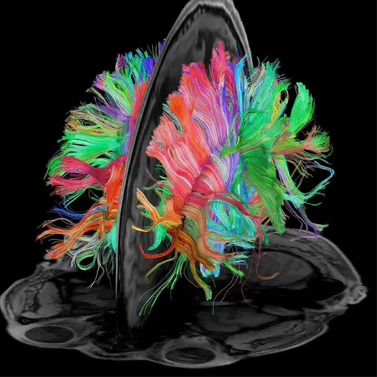 MRI Tractography | Test Price in Delhi | Ganesh Diagnostic