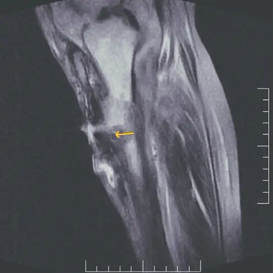 MRI Right Leg | Test Price in Delhi | Ganesh Diagnostic