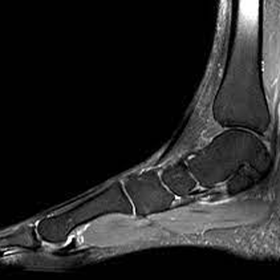 MRI TOE Test Near You in Delhi | Book Test at Low Price