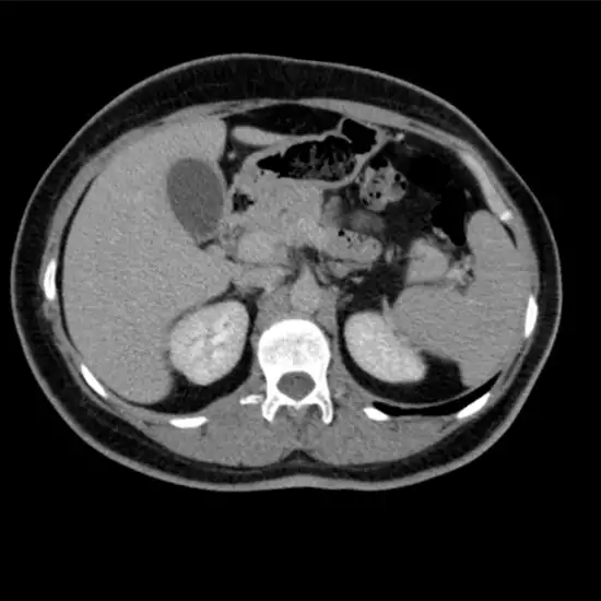 CECT Triple Phase Upper Abdomen | Test Price in Delhi