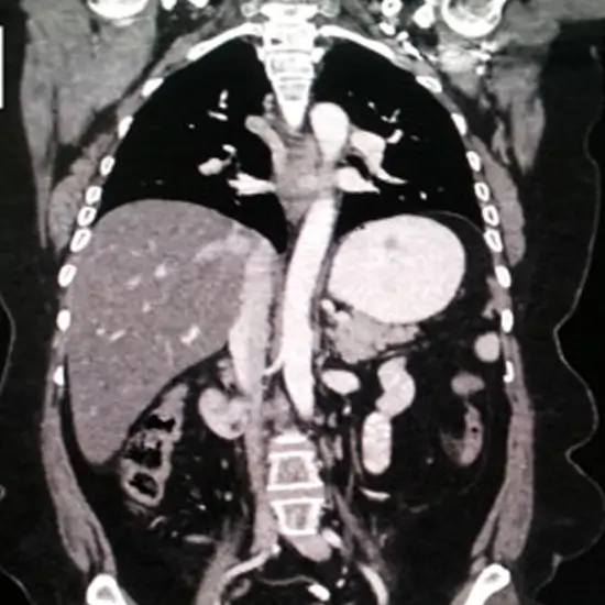 CECT Chest & Upper Abdomen | Test Price in Delhi | Ganesh Diagnostics