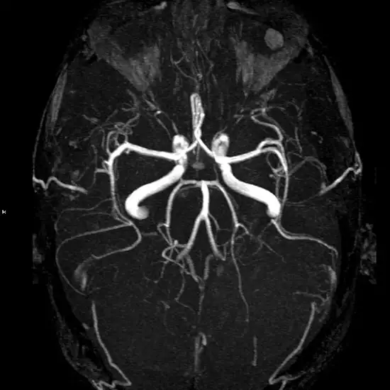 MR Angiography Brain T2W Scan Test Near You in Delhi | Book Test at Low ...