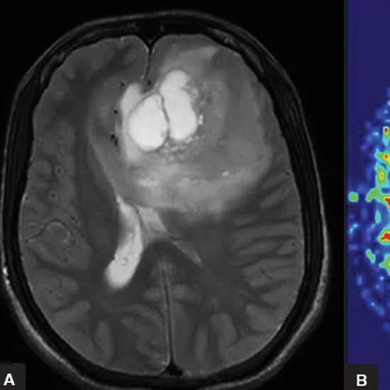 MRI Brain Perfusion Scan Test Near You in Delhi | Book Test at Low Price