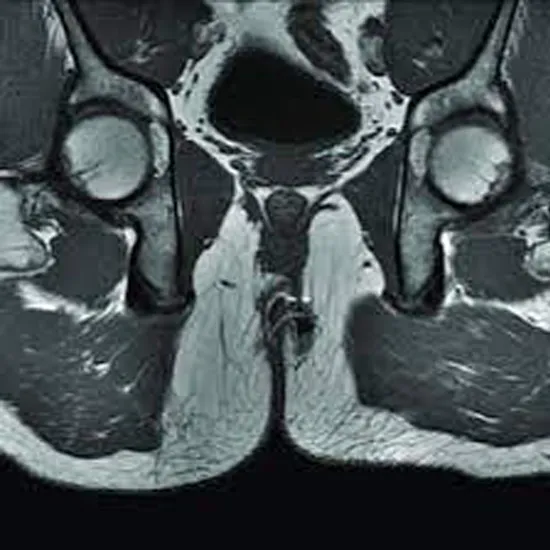 MRI Screen Fistulography | Test Price in Delhi | Ganesh Diagnostic