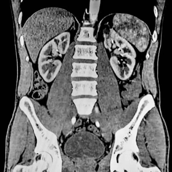 MRI Whole Abdomen | Test Price in Delhi | Ganesh Diagnostic