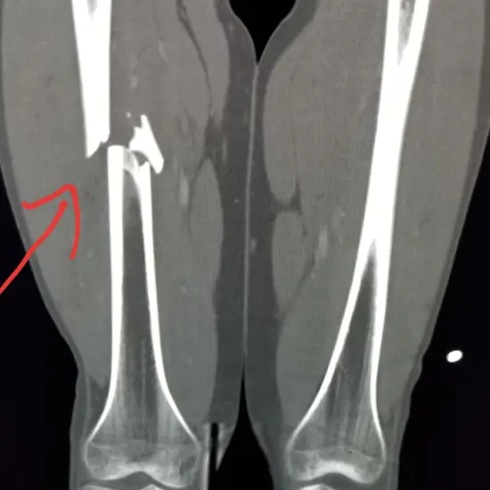 CECT Right Thigh | Test Price in Delhi | Ganesh Diagnostic