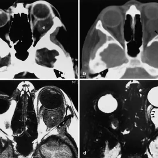 CT Orbit Scan | Test Price in Delhi | Ganesh Diagnostic