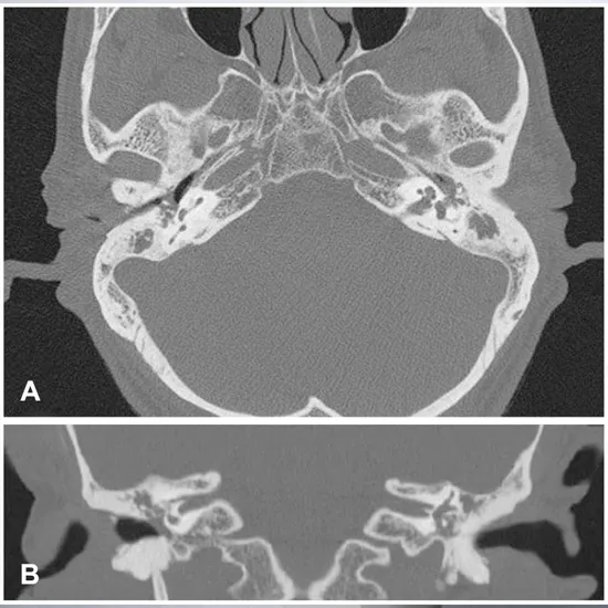 CECT Inner Ear (Axial And Coronal) | Test Price in Delhi