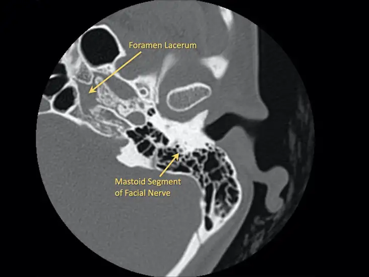 NCCT Temporal Bone Axial | Test Price in Delhi | Ganesh Diagnostic