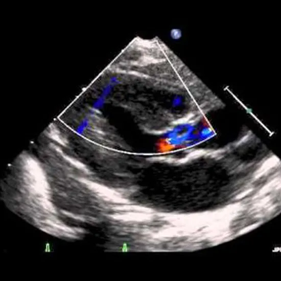 Pediatric Echocardiography | Test Price in Delhi | Ganesh Diagnostic