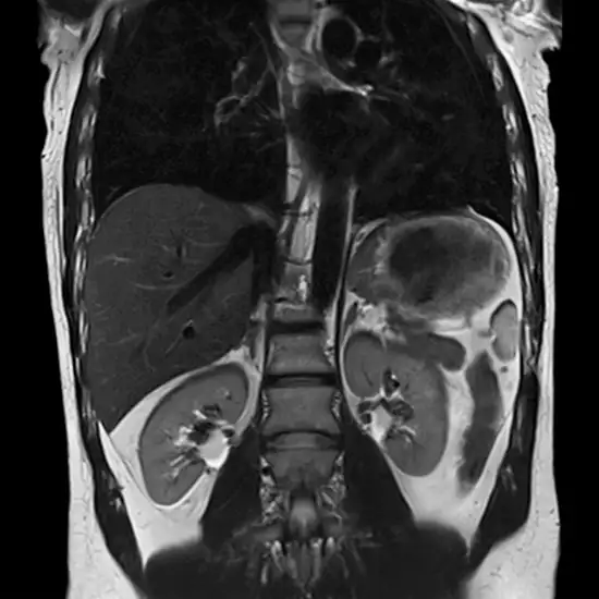 MRI Abdomen With Contrast | Test Price in Delhi | Ganesh Diagnostic