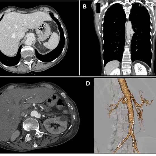 CT Aortic Angiography | Test Price in Delhi | Ganesh Diagnostic