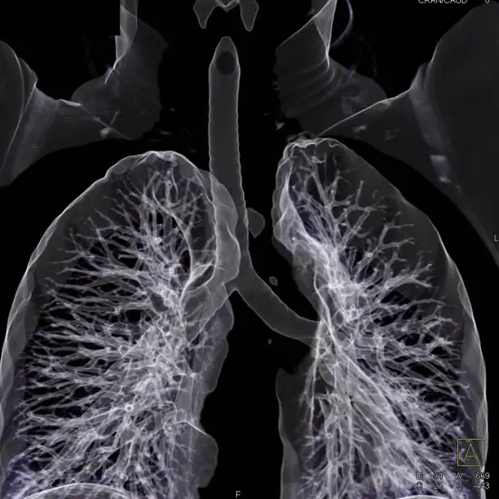 CT Virtual Bronchoscopy | Test Price in Delhi | Ganesh Diagnostic