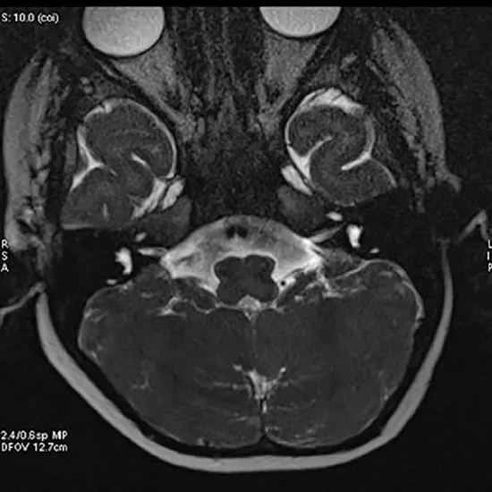 MRI Internal EAR | Test Price in Delhi | Ganesh Diagnostic