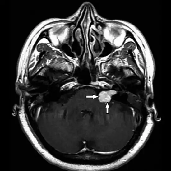 MRI Temporal Bone | Test Price in Delhi | Ganesh Diagnostic