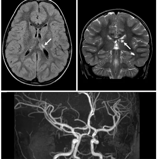 MRI & MR Angiography Brain Scan | Test Price in Delhi | Ganesh Diagnostic