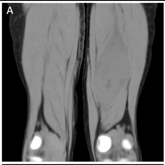 CT bilateral Thigh & Leg | Test Price in Delhi | Ganesh Diagnostic