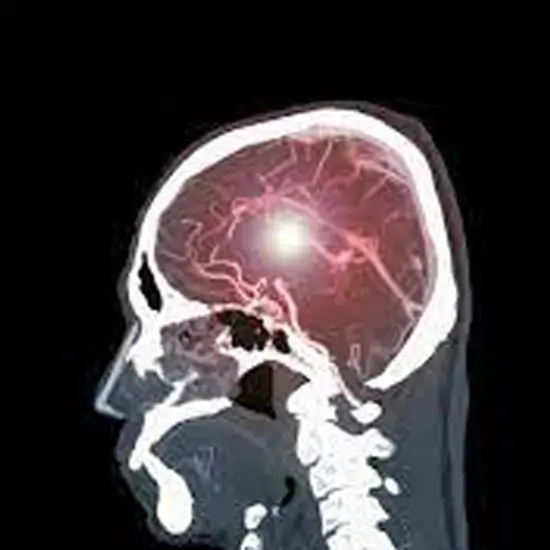 CT Head & Neck Angiography | Test Price in Delhi | Ganesh Diagnostic