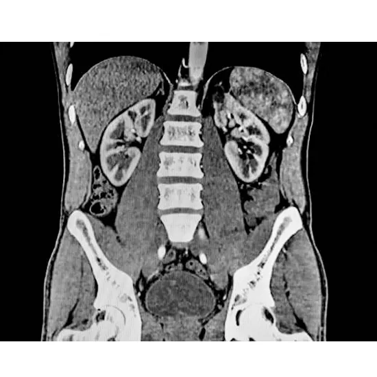 MRI Upper Abdomen | Test Price in Delhi | Ganesh Diagnostic