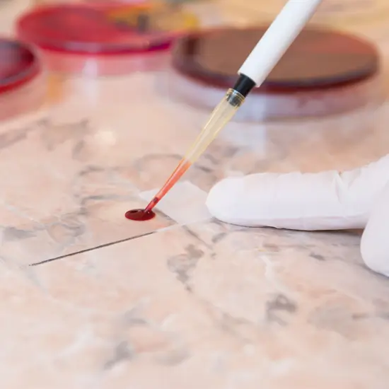 Peripheral Blood Smear | Test Price In Delhi | Cost Near Me, India ...