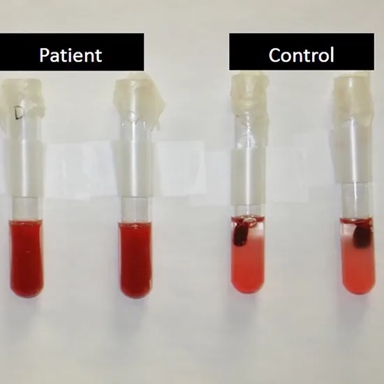 CRT (Clot Retraction Time) | Test Price In Delhi | Cost Near Me, India ...