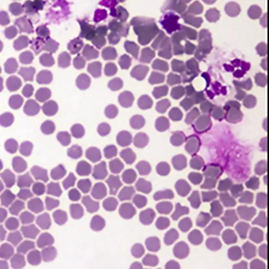 Smear For Microfilaria (MF | Test Price In Delhi | Cost Near Me, India ...