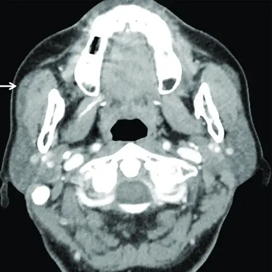 MRI Sialography Test Near You in Delhi | Book Test at Low Price