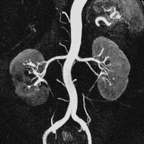 MR Angiography Renal With Contrast | Test Price in Delhi | Ganesh ...