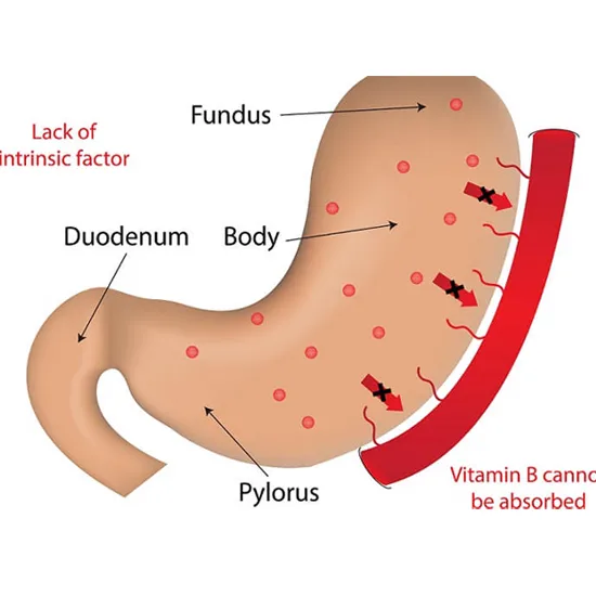 Intrinsic Factor Antibodies | Test Price in Delhi | Ganesh Diagnostic