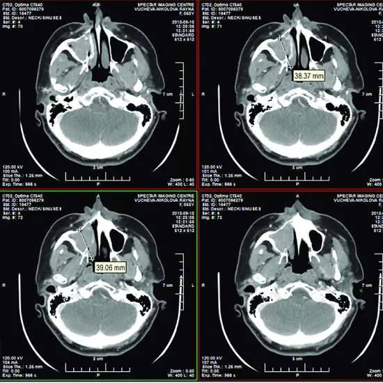 CT scan Maxilla Axial | Test Price in Delhi | Ganesh Diagnostic