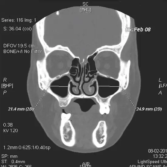 CT scan Maxilla Coronal | Test Price in Delhi | Ganesh Diagnostic