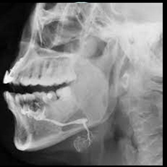 X-ray Sialogram | Test Price in Delhi | Ganesh Diagnostic