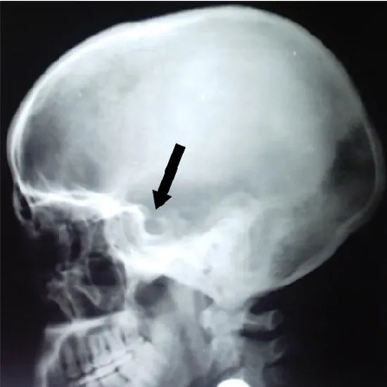 X-ray Skull LAT Coned View for Sella | Test Price in Delhi | Ganesh ...