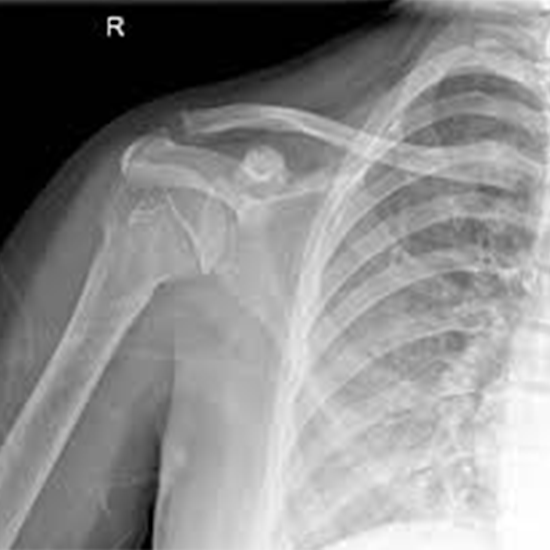 X-ray Right Shoulder LAT | Test Price in Delhi | Ganesh Diagnostic