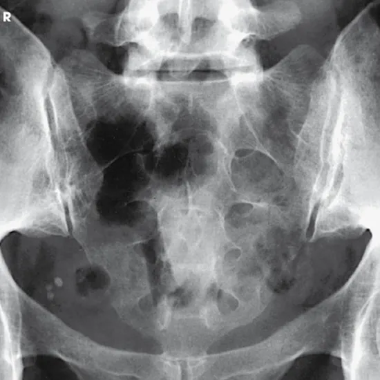 X-ray SI Joint PA View | Test Price in Delhi | Ganesh Diagnostic