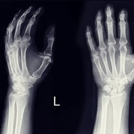 X-ray Right Wrist AP & Lateral Views | Test Price in Delhi | Ganesh ...