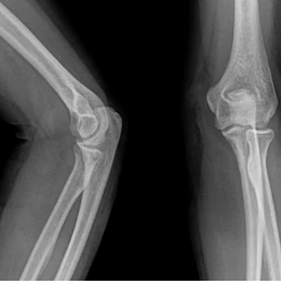 X-ray Right Elbow AP & Lateral | Test Price in Delhi | Ganesh Diagnostic