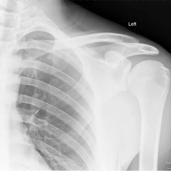 X-ray Right Scapula AP/Lateral | Test Price in Delhi | Ganesh Diagnostic