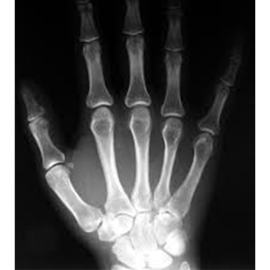 X-ray Right Thumb AP View | Test Price in Delhi | Ganesh Diagnostic