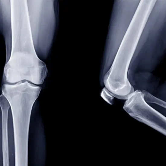 X-ray Right Patella LAT & AP | Test Price in Delhi | Ganesh Diagnostic