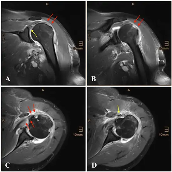 MRI Left Shoulder | Test Price in Delhi | Ganesh Diagnostic