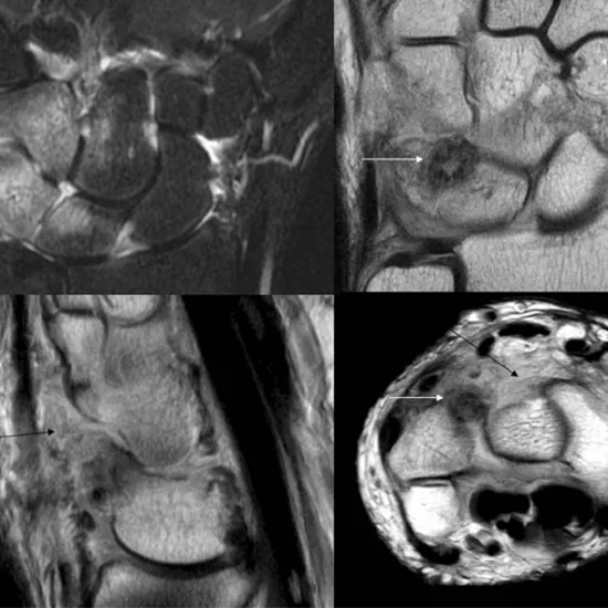 MRI Left Wrist | Test Price In Delhi | Cost Near Me, India | Ganesh ...