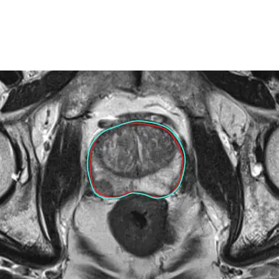 MRI Prostate Scan Test Near You in Delhi | Book Test at Low Price