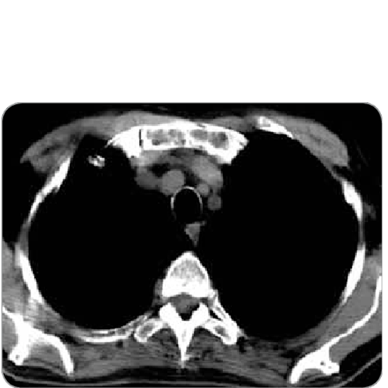 MRI Screening Of Sternum Test Near You in Delhi | Book Test at Low Price