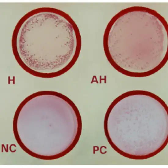 Widal Slide Test Cost In Delhi Widal Test Price India | Ganesh Diagnostic