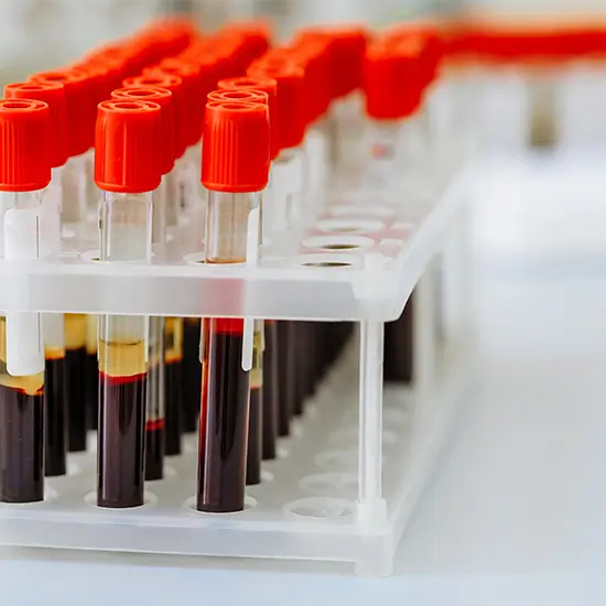 ESR Westergren Method Test Near You in Delhi | Book Test at Low Price