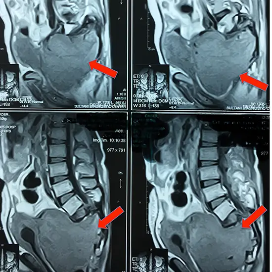 MRI Sacrum Scan Test Near You in Delhi | Book Test at Low Price