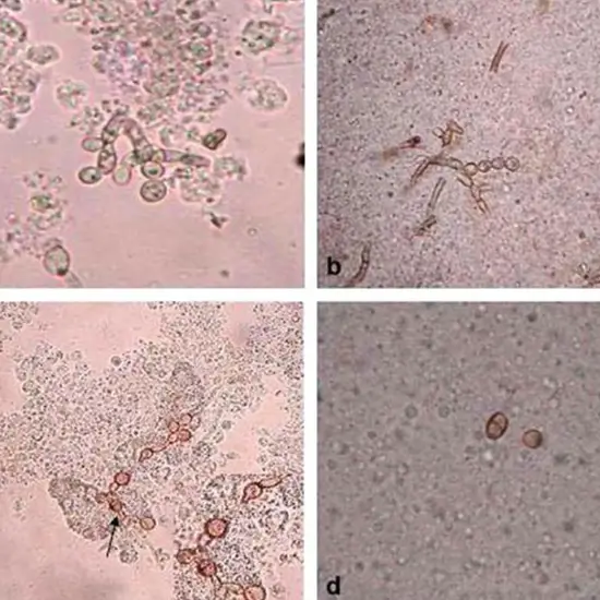 Smear For Fungal Examination | Test Price in Delhi | Ganesh Diagnostic