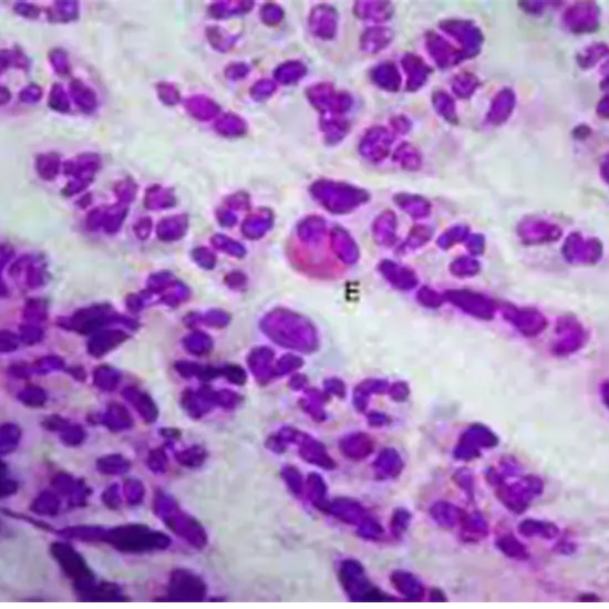 Nasal Smear For Eosnophilla | Test Price in Delhi | Ganesh Diagnostic